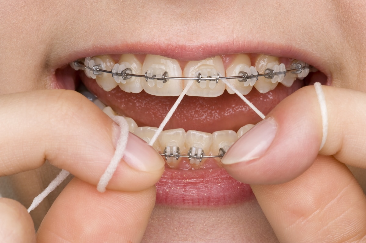 Zahnspange & Karies: Ein Risiko? Was kann man tun? | DENTAL ONE®